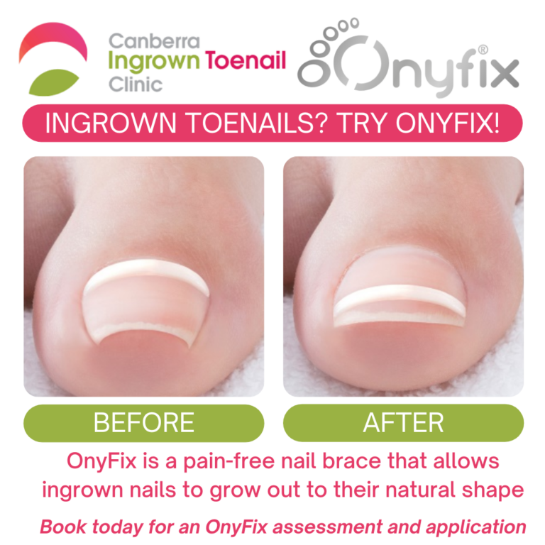 Onyfix Nail Bracing: Ingrown Toenail Care - Canberra Ingrown Toenail Clinic